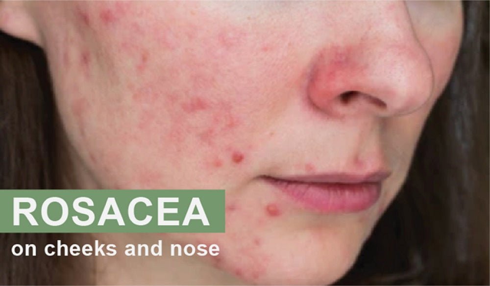 Rosacea on the Cheeks and Nose | All you need to know